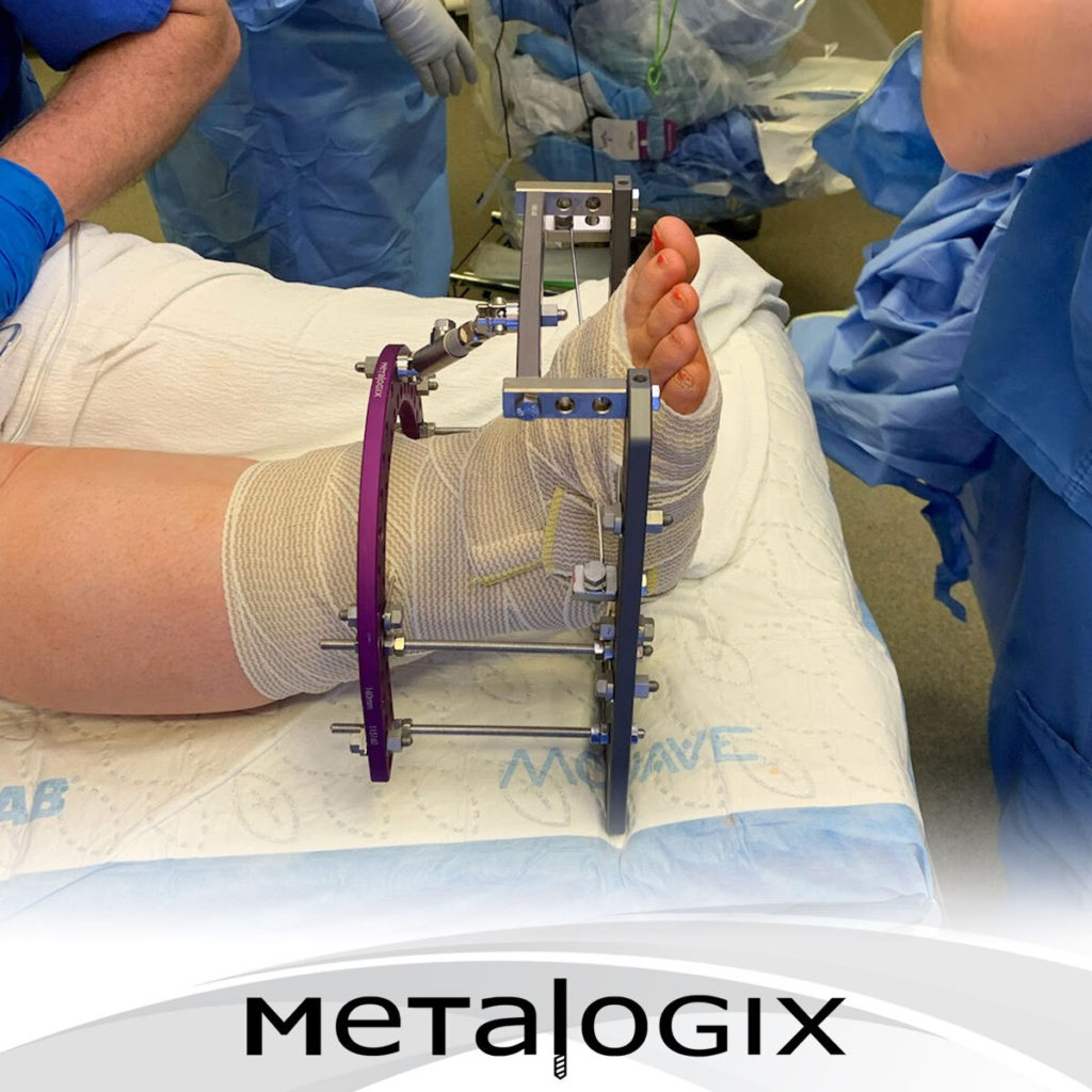 Ankle Distraction – Metalogix