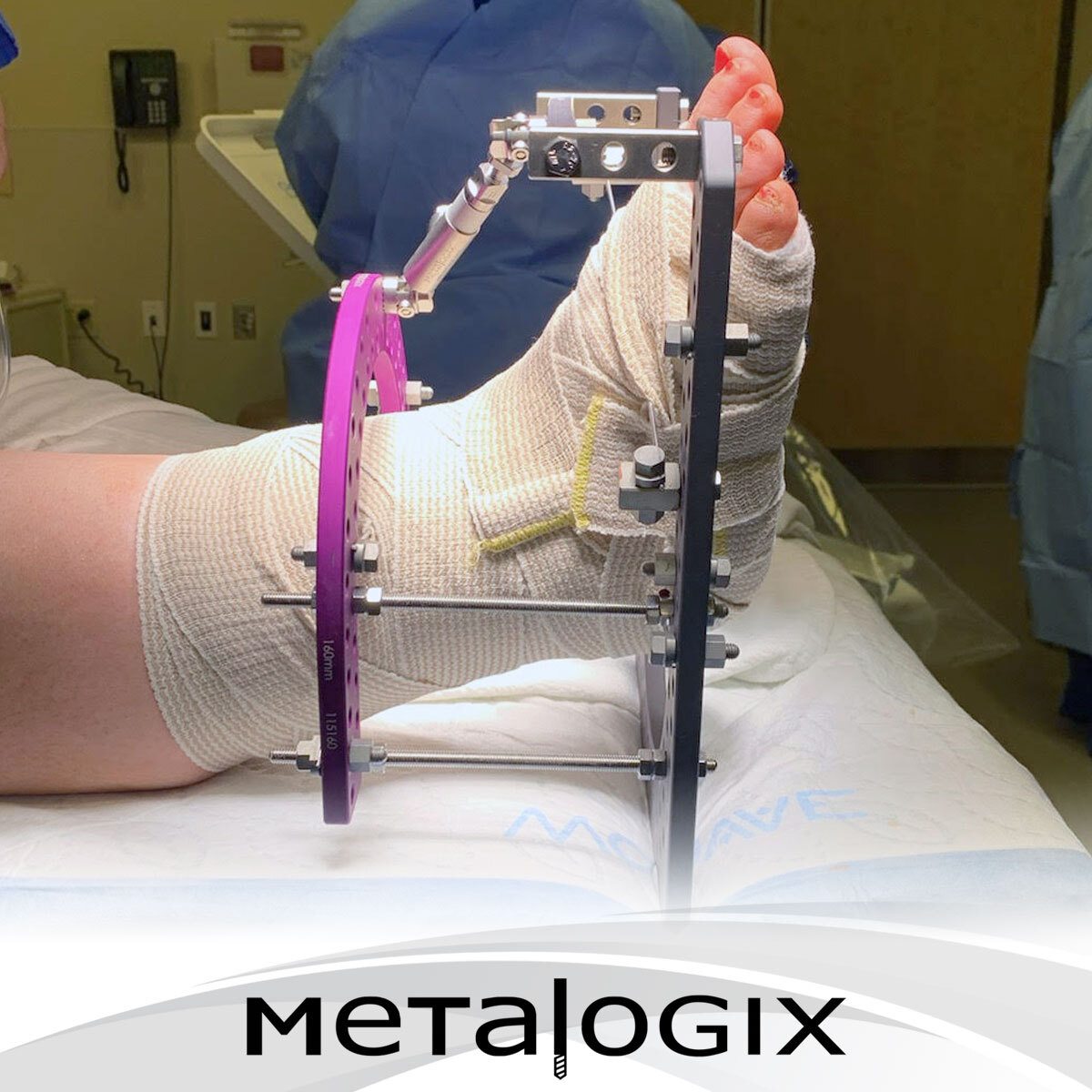 Ankle Distraction – Metalogix