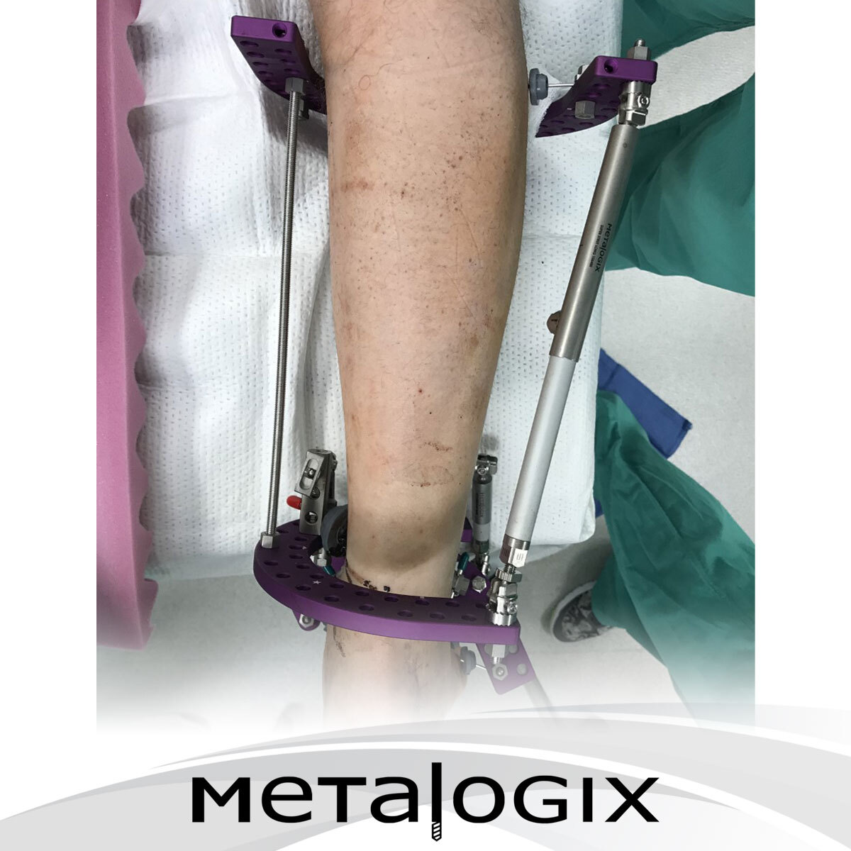 Reverse Sural Flap Case – Metalogix